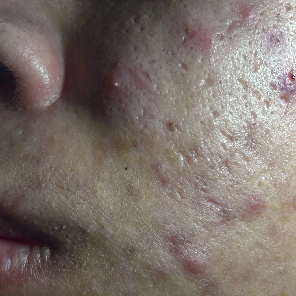 Acne Scarring | Acne Center of Michigan